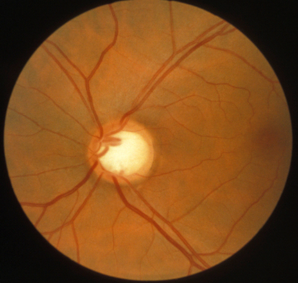 The Glaucomatous Disc | Ophthalmology Self-Guided Study Activity ...